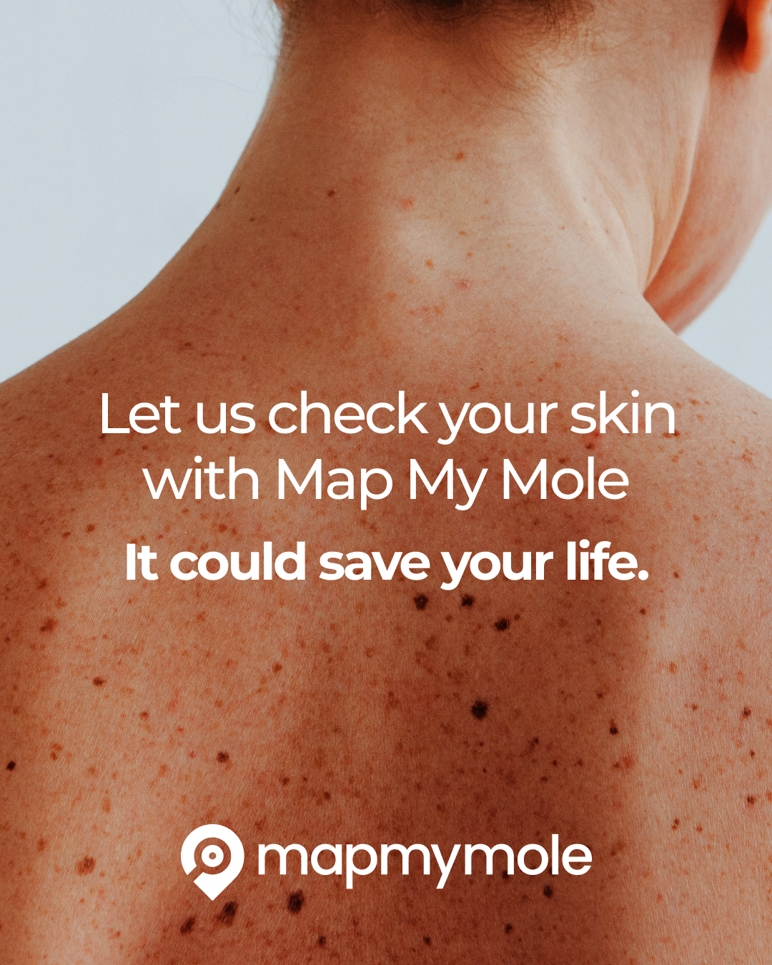 Map my Mole - Saddle House Medi-Spa